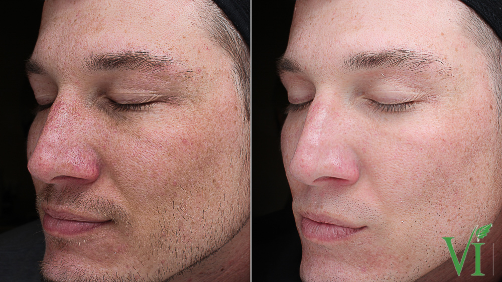 Vi Peel Exceptional Dermatology Care Vi Peel Exceptional Dermatology Care