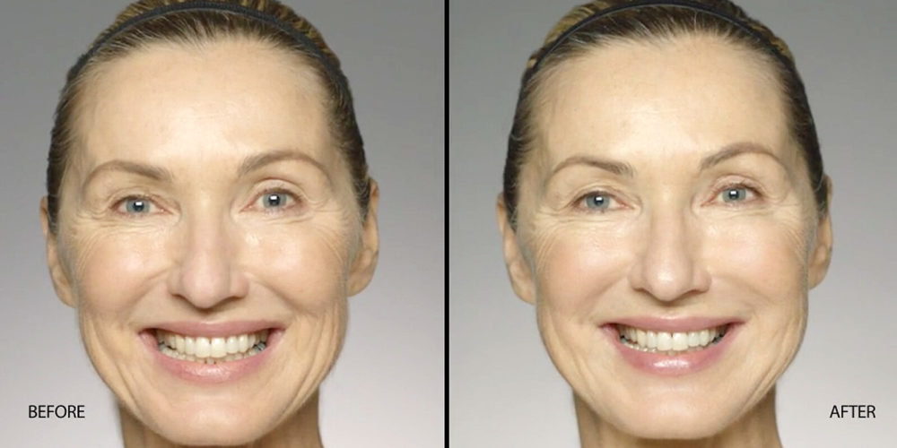 Restylane Refyne Fullerton | Exceptional Dermatology Care