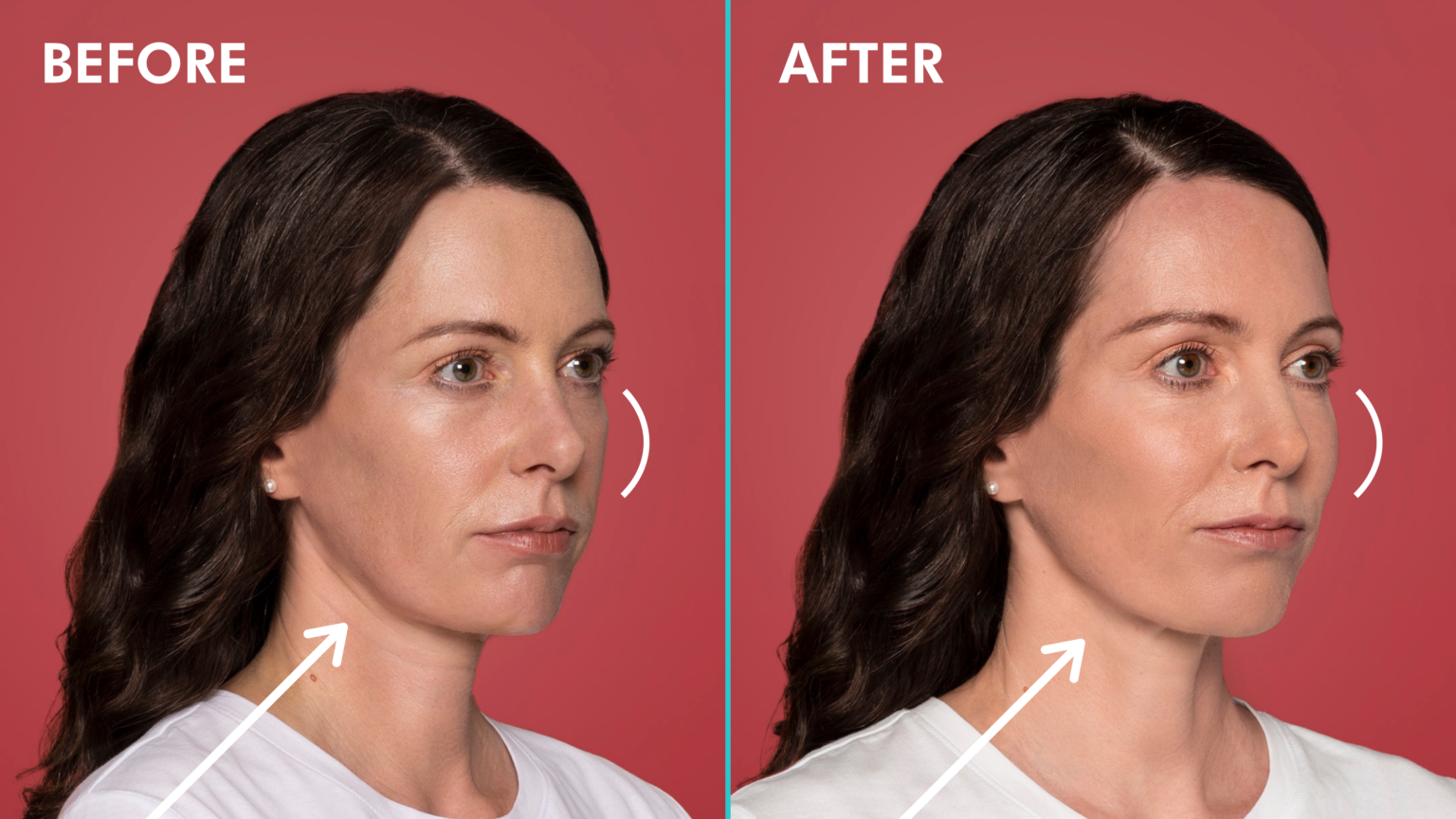 Restylane Contour Fullerton | Exceptional Dermatology Care