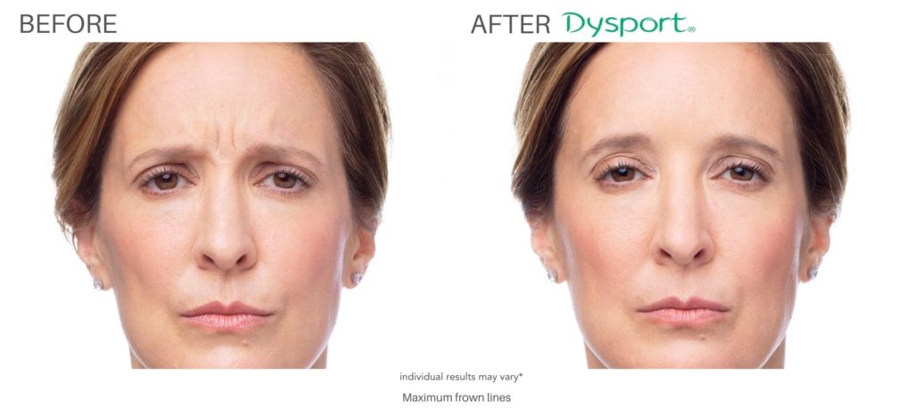 Dysport Injections | Exceptional Dermatology Care | Fullerton, CA