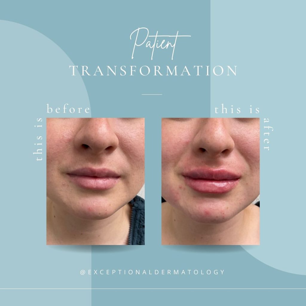 Restylane Kysse Fullerton | Exceptional Dermatology Care